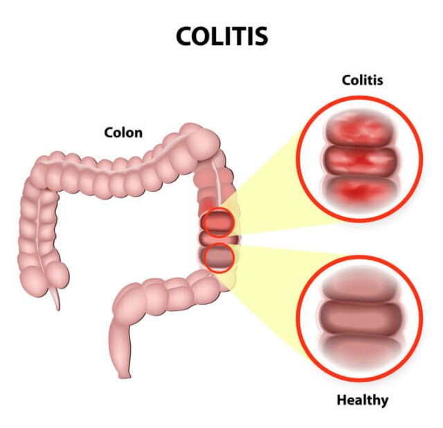 Symptoms Colitis, Ulcerative Colitis - Choose Your Life Style